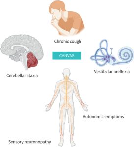 Article sur le syndrome de CANVAS et son lien avec une toux neurogène ...